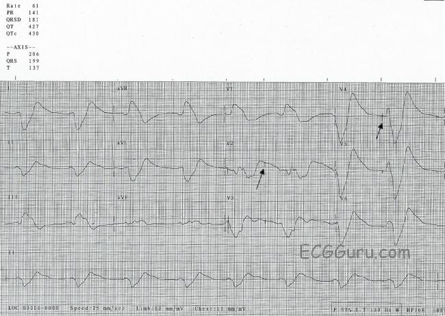 Wide-complex rhythm | ECG Guru - Instructor Resources Wide-complex rhythm | ECG Guru - Instructor Resources